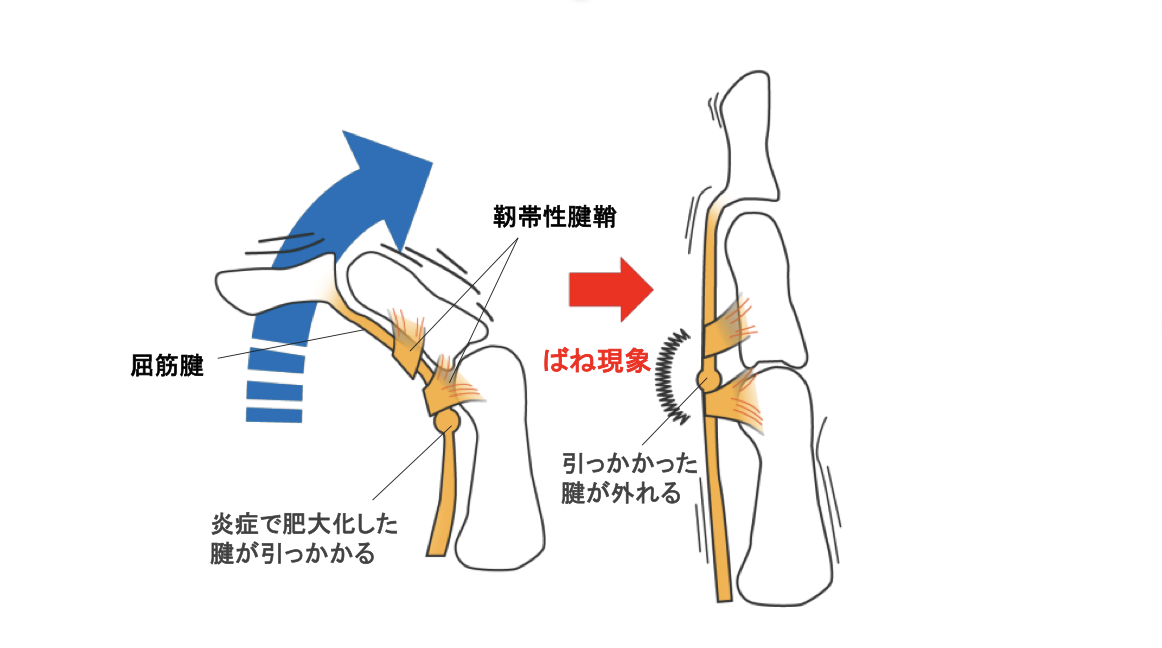 ばね指 | 佐藤整形外科医院 | 石巻市